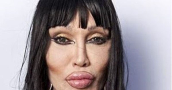 Desastre do botox e da plástica! Essas cirurgias deram muito errado ...