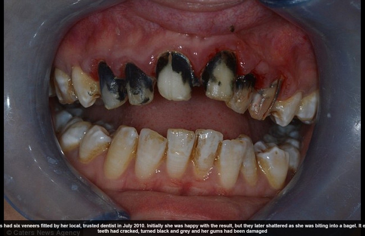 Desesperada com dentes pretos, mulher gasta R$ 30 mil em tratamento ...