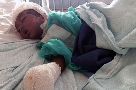 Bebê vítima de queimadura foge da Líbia e recebe tratamento na Sicília ...