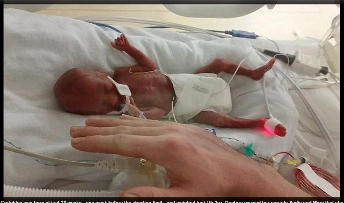 Bebê com 400 g desafia médicos que deram a ela apenas 1% de chance de ...