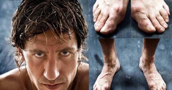 Imagens fortes! Os 10 pés mais feios do mundo da bola - Fotos - R7 Futebol