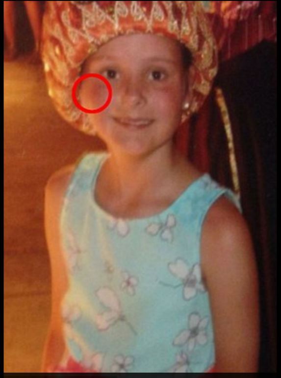 Família confunde câncer com picada de inseto e menina perde pedaço do ...