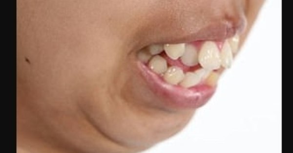 Jovem que nasceu sem queixo e com dentes para frente se transforma ...