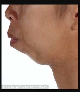 Jovem que nasceu sem queixo e com dentes para frente se transforma ...