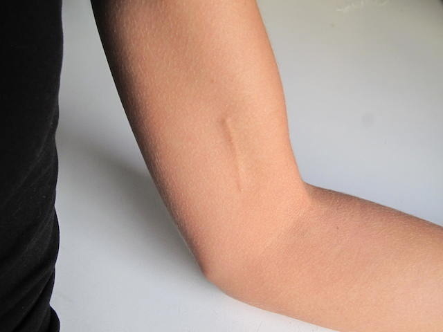 Conheça o implante subcutâneo: método contraceptivo que promete ...