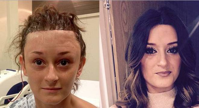 Frontoplastia: Cirurgia que diminui testa funciona de verdade? Quanto ...