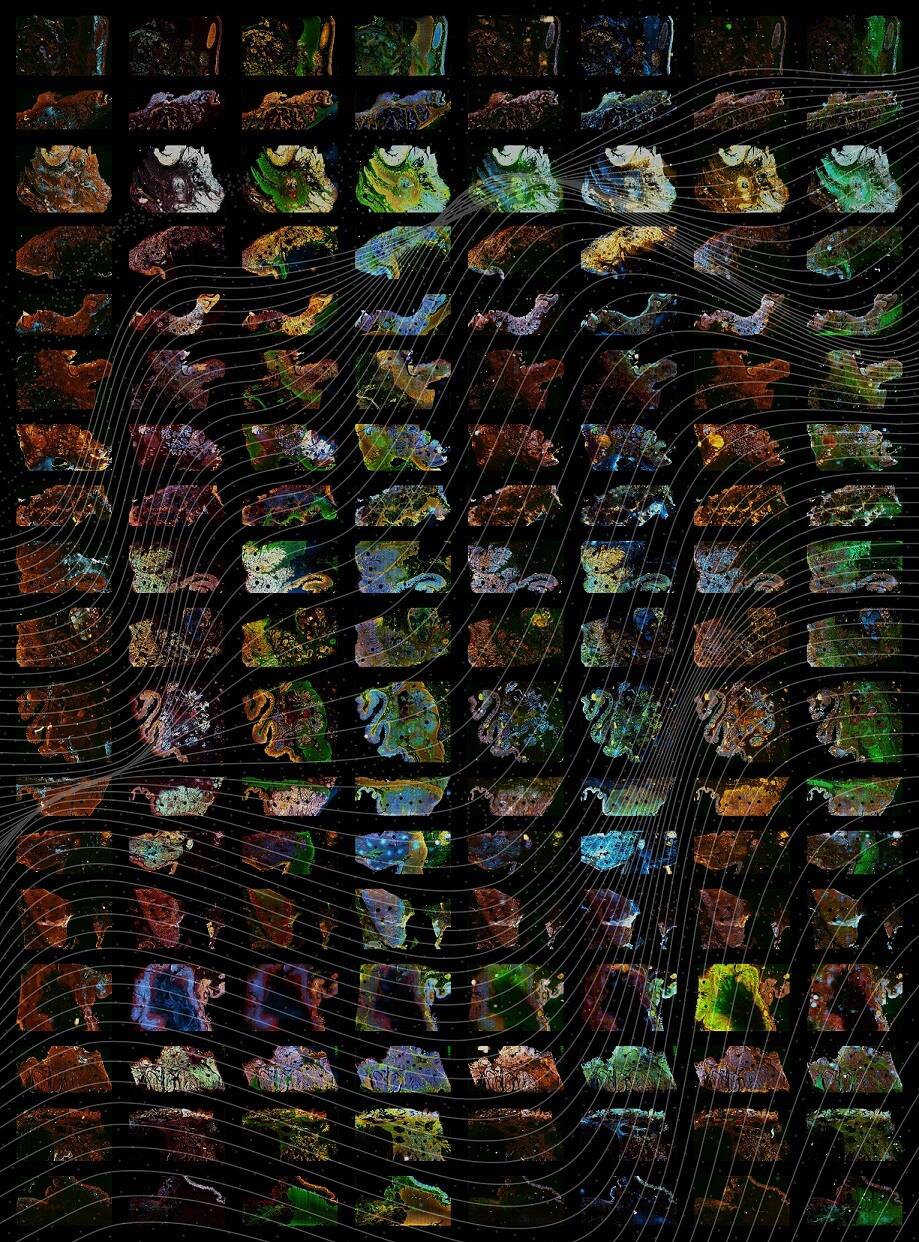 Mapas em 3D inéditos do câncer colorretal podem ajudar no tratamento da ...