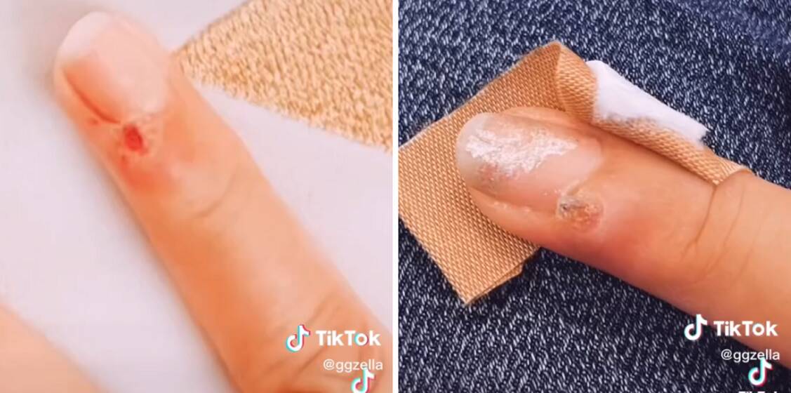 Mulher desenvolve câncer de pele após ter o dedo cortado por manicure ...