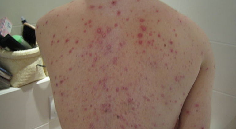 Quais outras doenças podem ser confundidas com a varíola do macaco ...