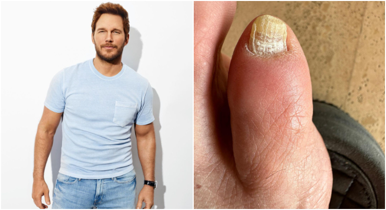 Galã de Hollywood, Chris Pratt posta unha do pé, e web suplica: 'Deleta ...