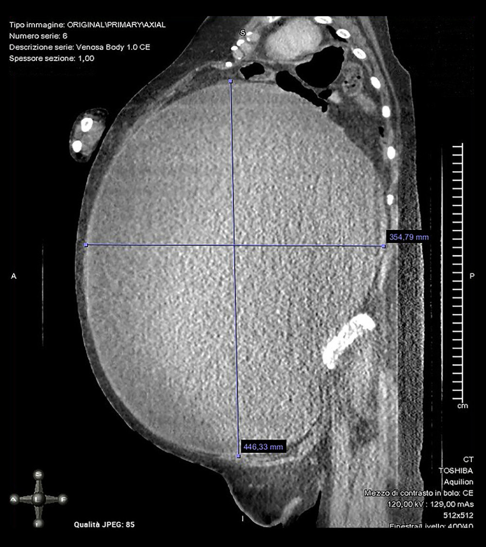 Mulher acredita estar com obesidade e retira cisto ovariano de 5 kg ...