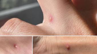 Estado de SP confirma primeira morte por varíola do macaco - Notícias ...