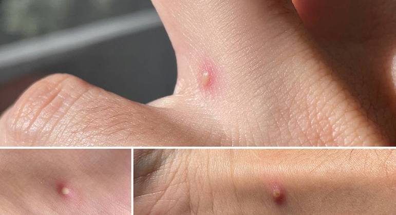 Varíola do macaco pode se tornar endêmica no Brasil por falta de plano ...