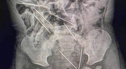 Menino de 2 anos engole 8 agulhas e passa por cirurgia no Peru ...