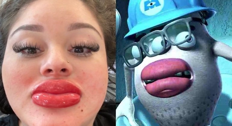 Mulher fica com bocão após procedimento e se compara a personagem de ...