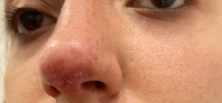 Câmara hiperbárica recupera nariz necrosado após procedimento estético ...