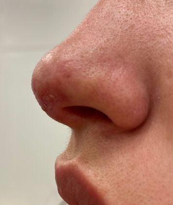 Câmara hiperbárica recupera nariz necrosado após procedimento estético ...