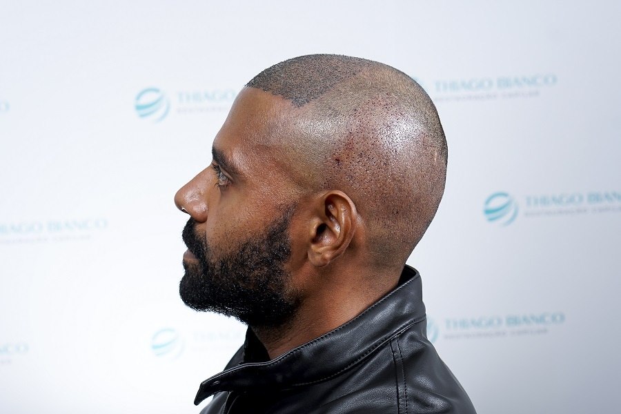 Pablo faz cirurgia de transplante capilar e exibe resultado ...