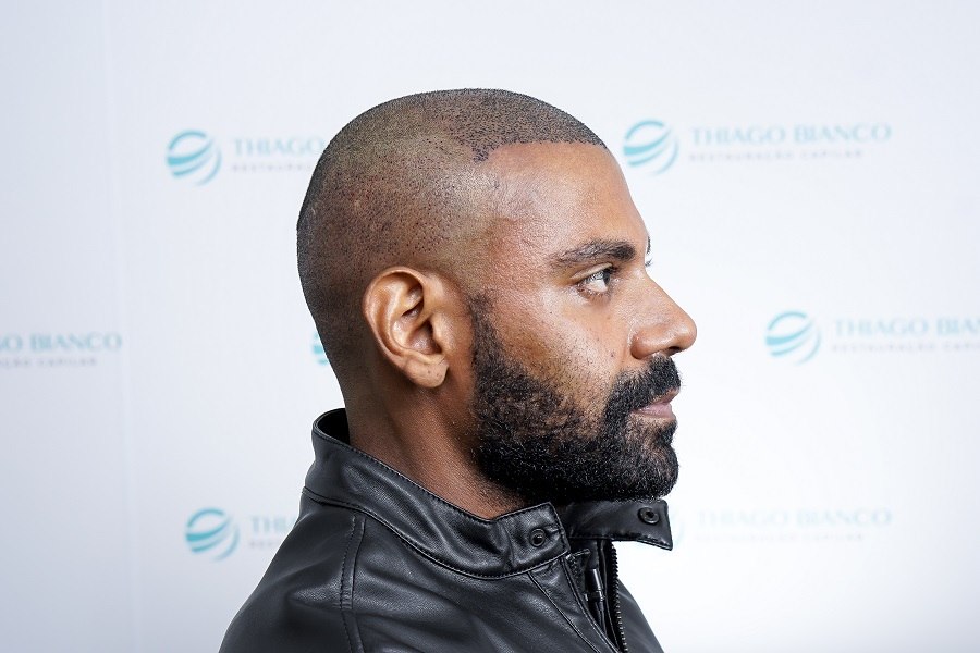 Pablo faz cirurgia de transplante capilar e exibe resultado ...