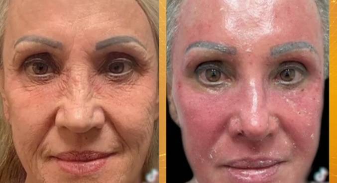 Saiba quais os riscos do peeling de fenol - RecordTV - R7 Fala Brasil