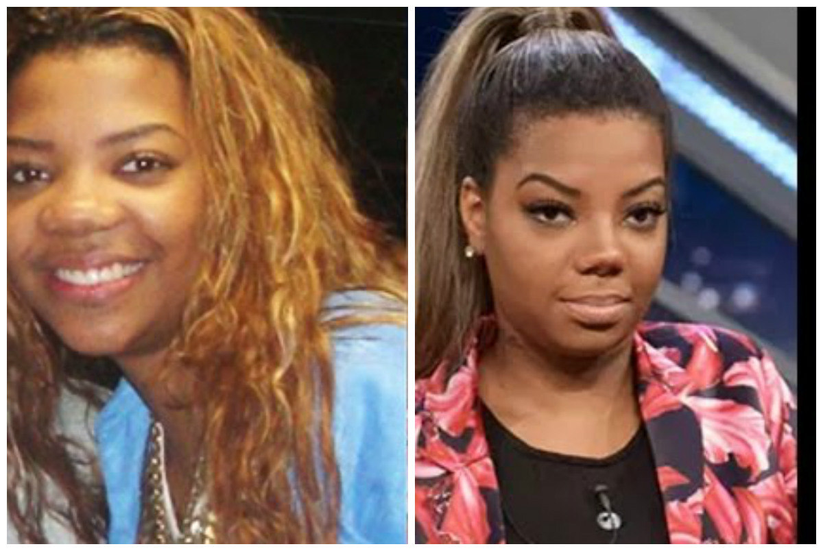 Saiba mais sobre o procedimento estético que pode levar a necrose de ...