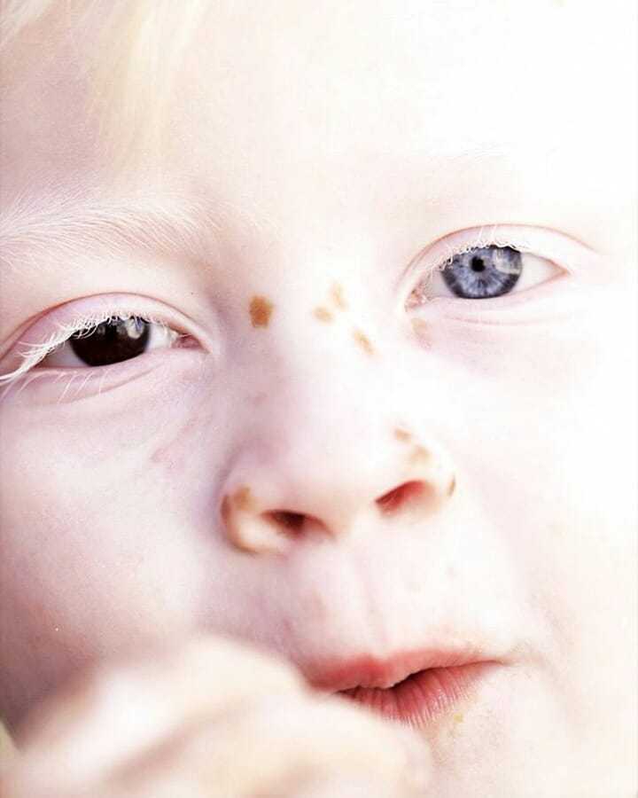 Entenda a síndrome do 'bebê platinado’ que encantou a web - Notícias ...