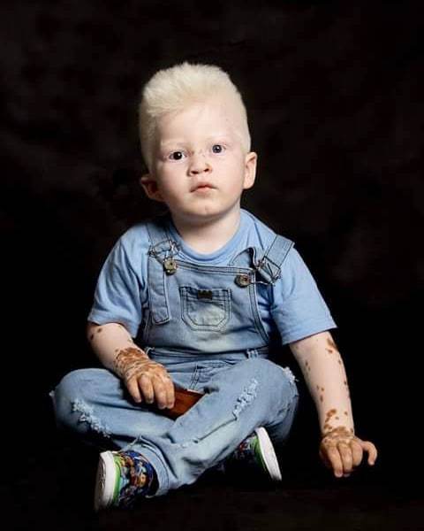 Entenda a síndrome do 'bebê platinado’ que encantou a web - Notícias ...