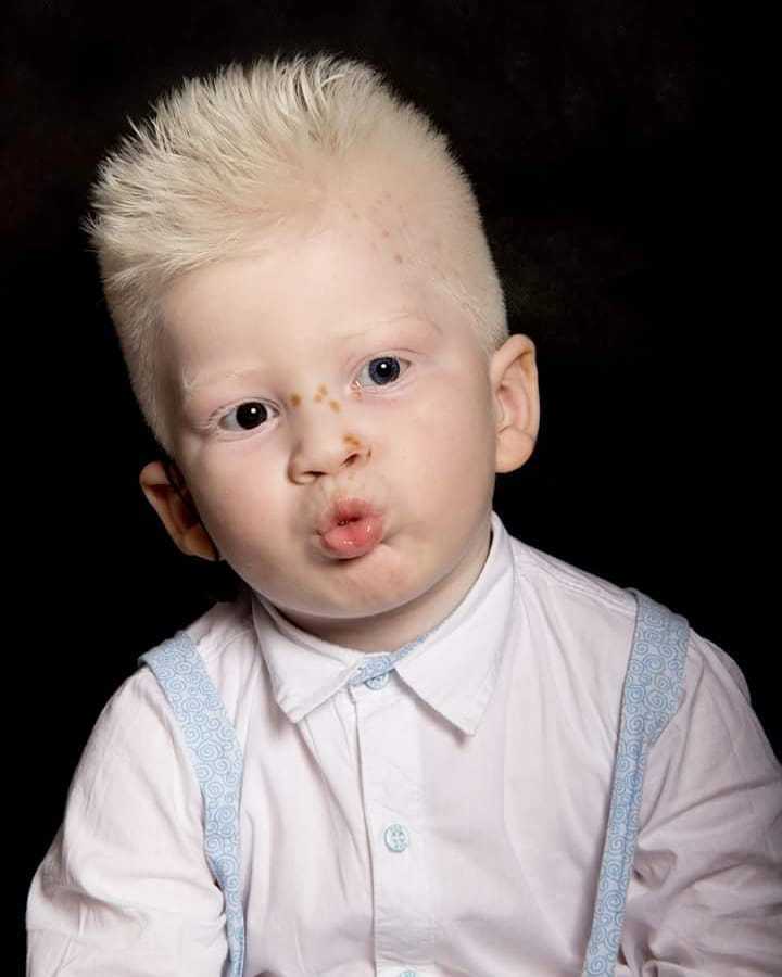Entenda a síndrome do 'bebê platinado’ que encantou a web - Notícias ...
