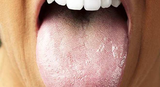 Saburra lingual – O que é e como tratar para ter uma boca saudável