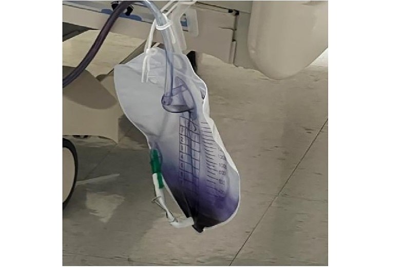 Médicos mostram raro caso de paciente com urina roxa; saiba por que ...