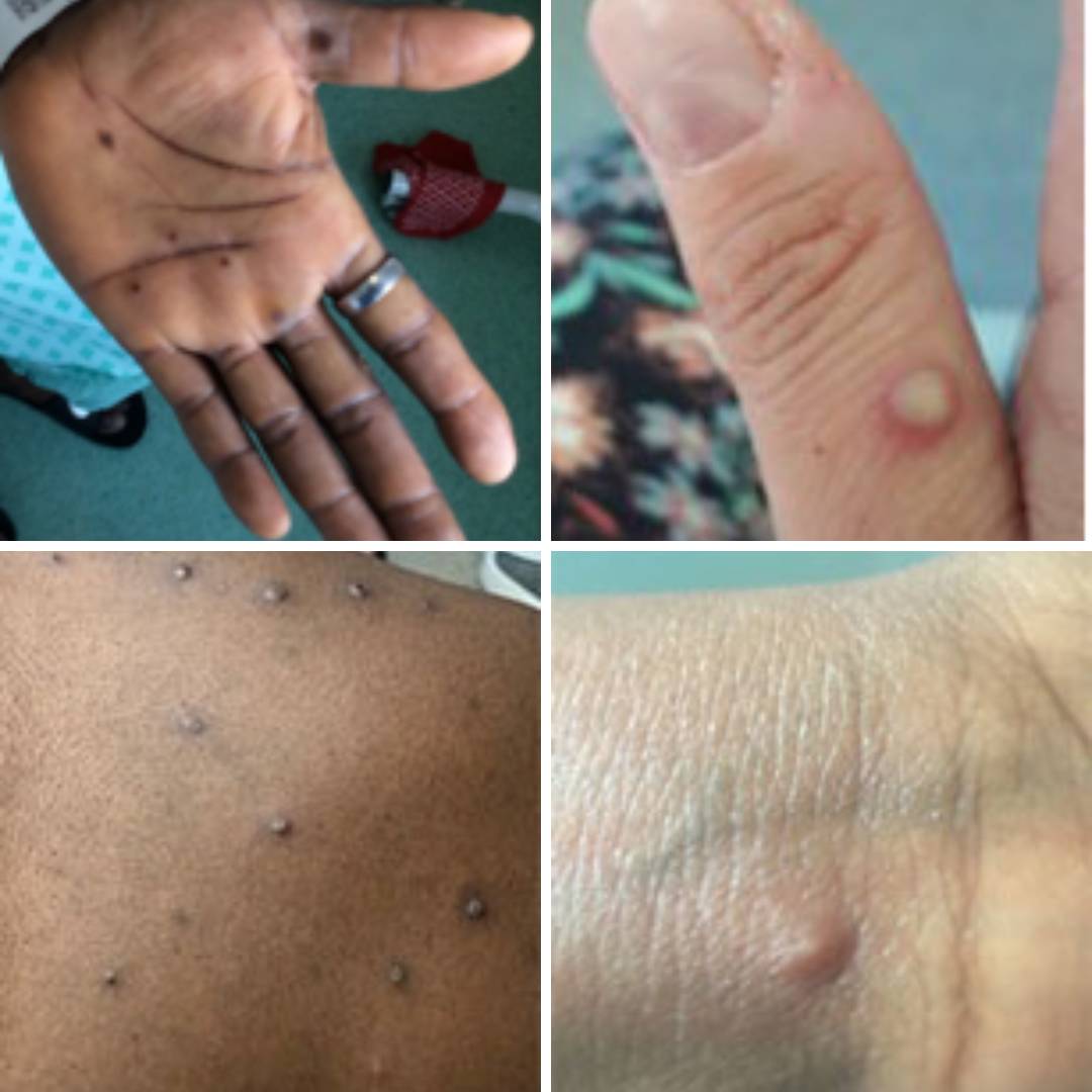 Transmissão e sintomas da varíola do macaco começam a ser definidos ...