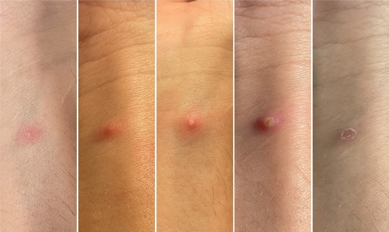 Estou com sintomas de varíola do macaco. O que devo fazer? - Fotos - R7 ...