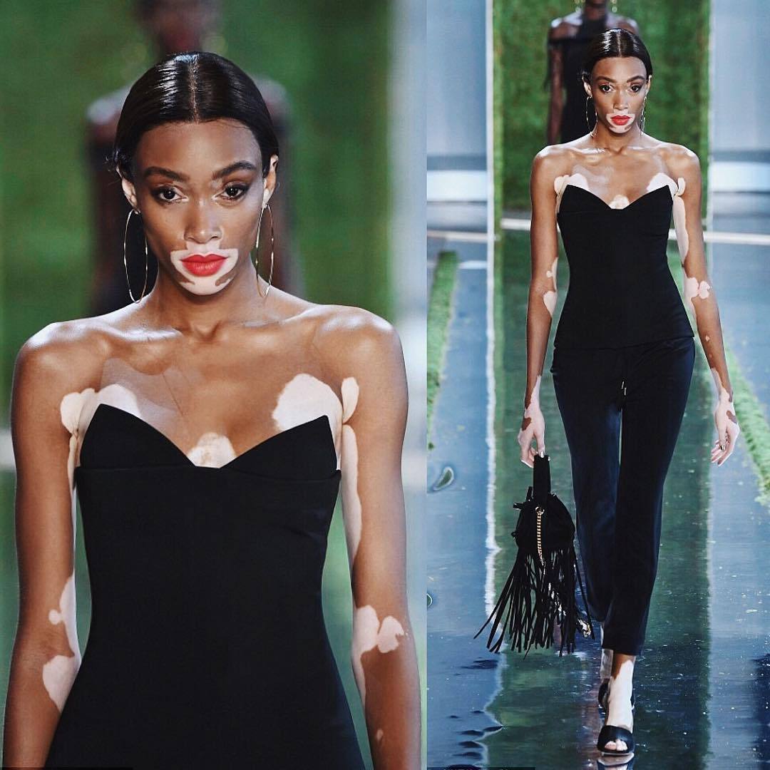 Modelo com vitiligo, Winnie Harlow será Angel da Victoria's Secret - R7 ...